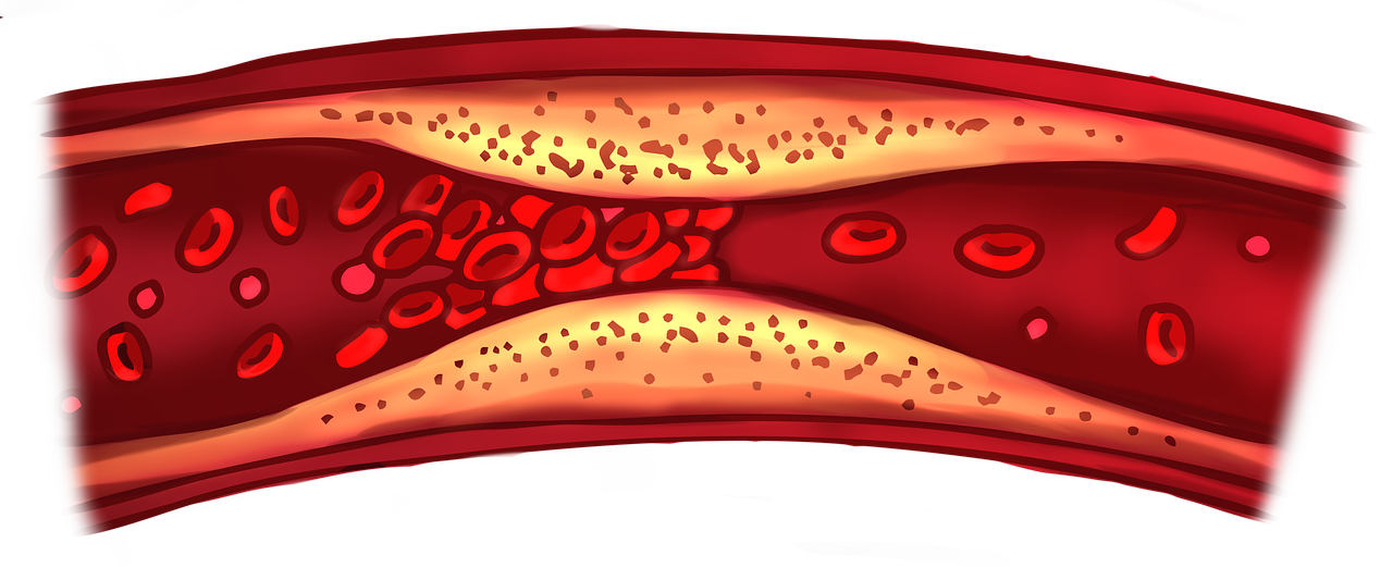 Spiritual Blockages That Circulatory Collapse Pressure and How to Heal ...